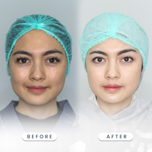 Miracle Radiance Whitening (Derma & Vital Injector) - Wijaya Platinum